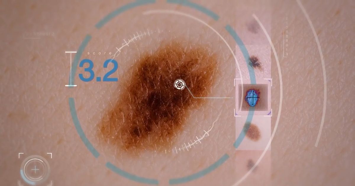 IBM OutThink Melanoma - GPJ ANZ